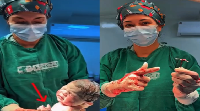 Médica compartilha vídeo de bebê segurando DIU após parto; veja