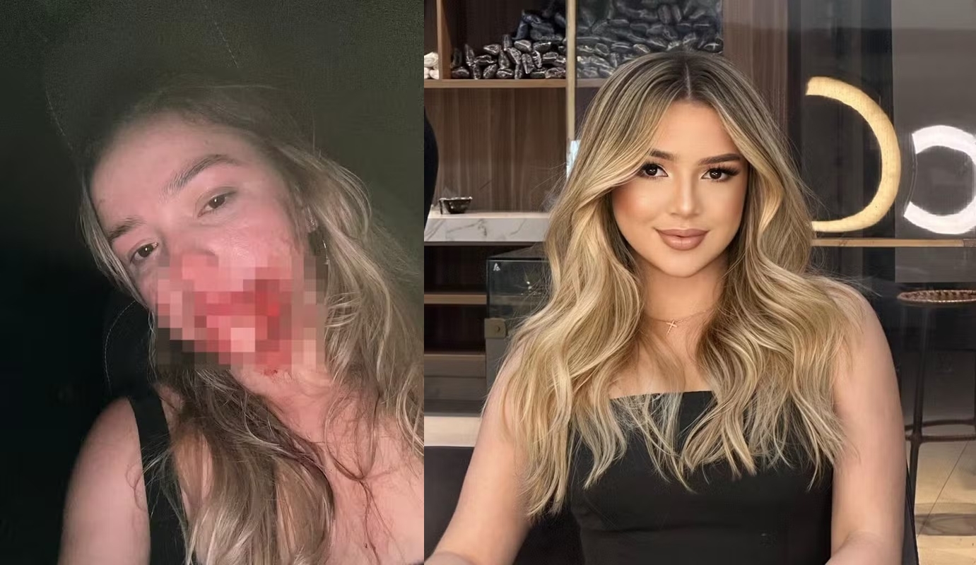 Modelo é agredida por síndico de prédio onde mora e fica com buraco no rosto