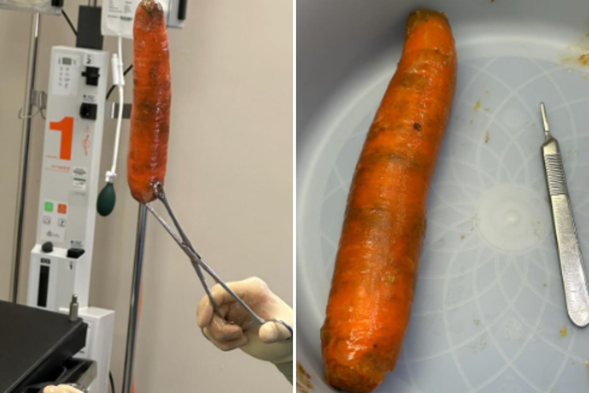 Homem Enfia Cenoura De 20 Cm No ânus E é Hospitalizado Com Urgência